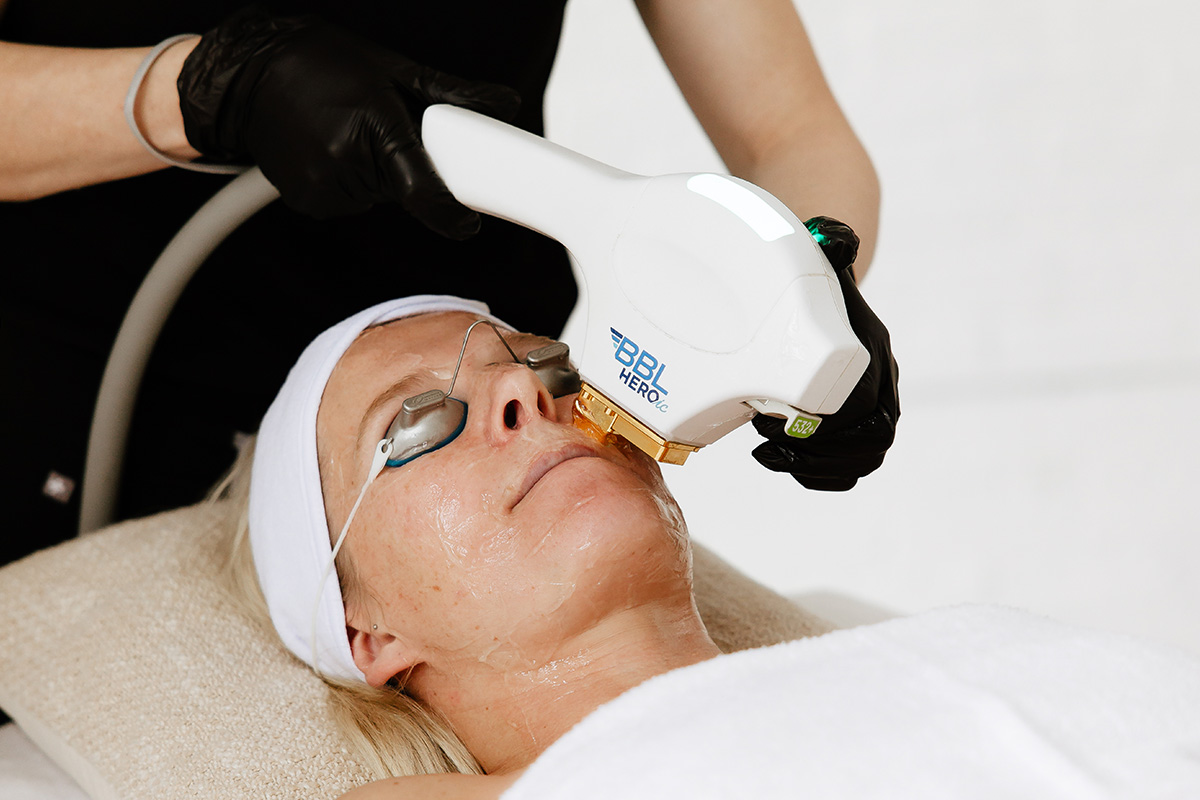 BBL Laser in Sequim, WA | Northwest Beauty & Wellness